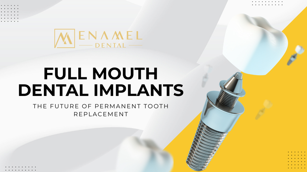 Why Full Mouth Dental Implants Are the Future of Permanent Tooth ...
